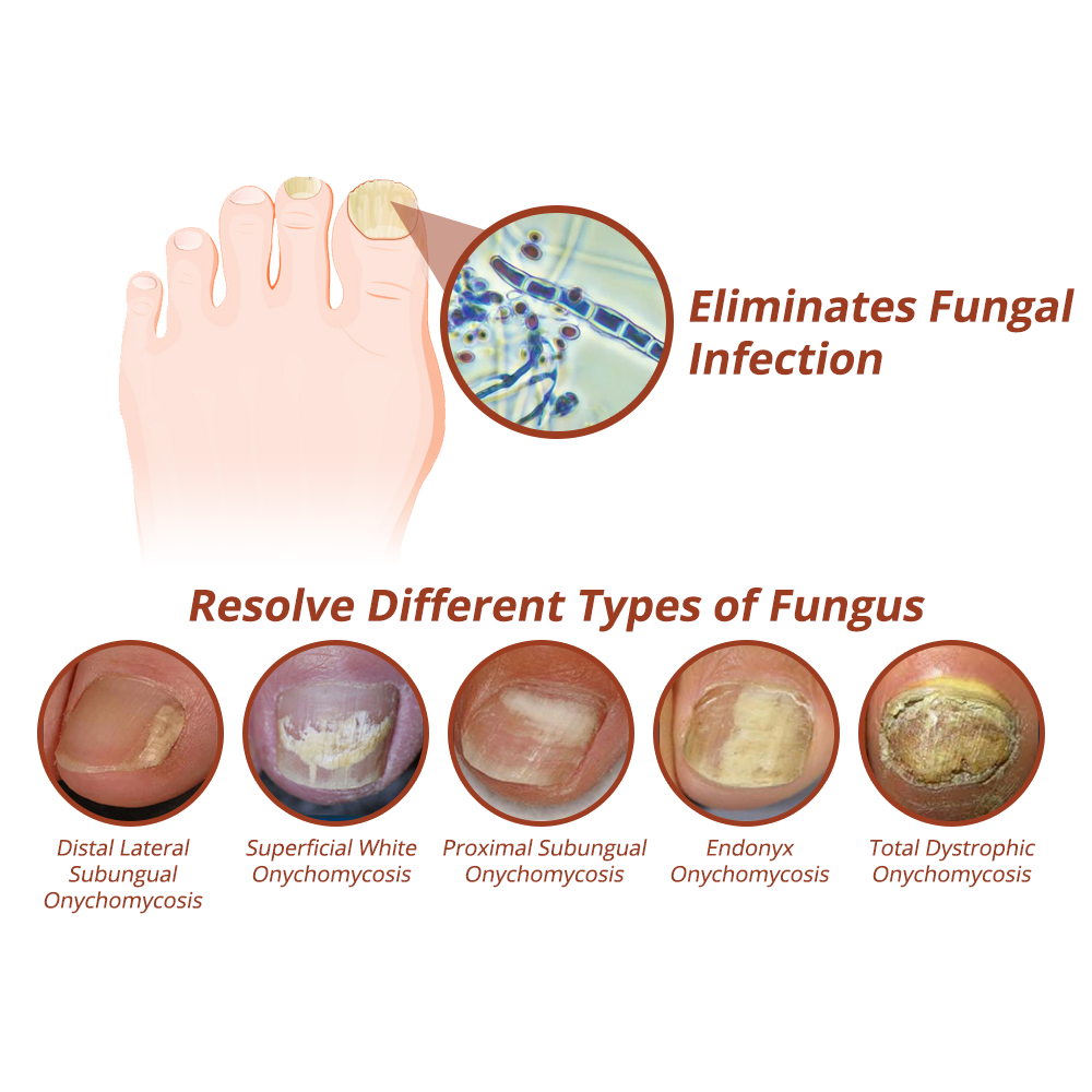 Total Dystrophic Onychomycosis