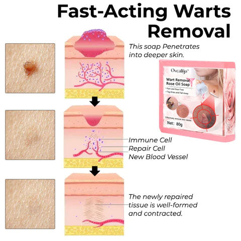 CC™ Wart Removal Rose Oil Soap – DEEPCLEANSING
