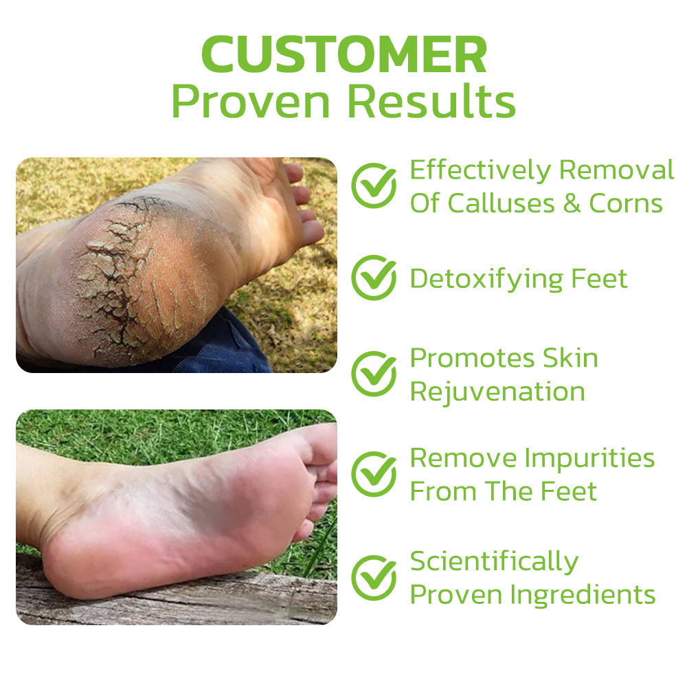 CC™ IHerbal Foot Callus And Corns Removal Soak – DEEPCLEANSING
